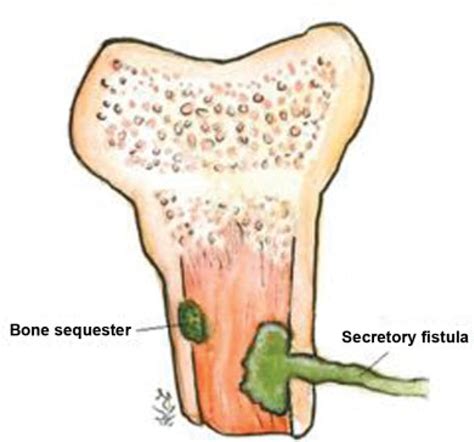 Osteomyelitis Sinus Infection Symptoms At Betty Sansbury Blog