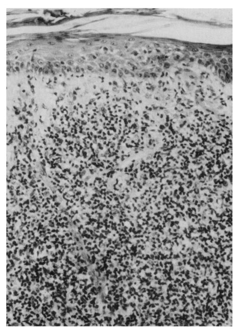 Dense Dermal Infiltrate Of Small Lymphoid Cells Presenting A Download Scientific Diagram