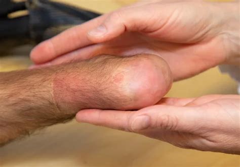 Forearm Amputation Hand And Nerve Surgeon