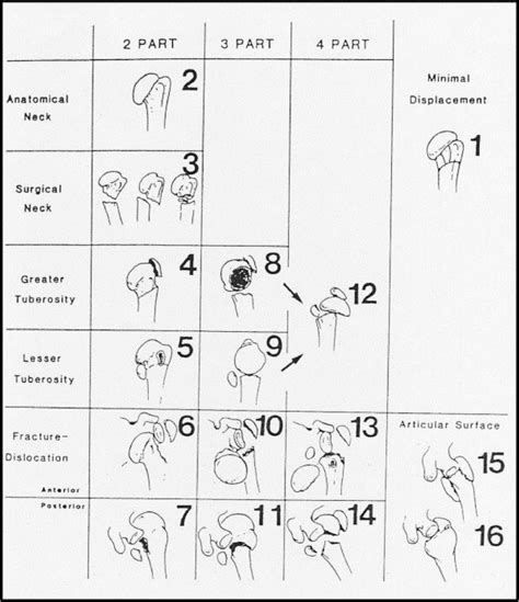 Neer Classification For Proximal Humeral Fractures The Profher Proximal Fracture Of The