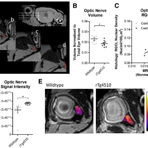 Reduced Optic Nerve Volume In Mapt Mutation Carrying Ftd Patients A
