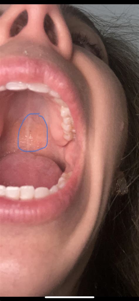Oral Melanoma Roralsurgery