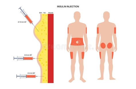 Lovenox Injection Sites