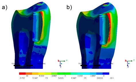 Computer Aided Design Modelling And Finite Element Analysis Of Premolar Proximal Cavities