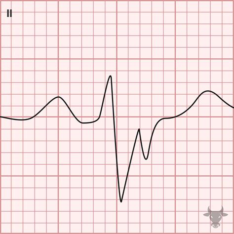 Bifascicular Block Ecg Stampede