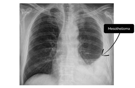Chest X Ray Interpretation A Structured Approach Radiology Osce