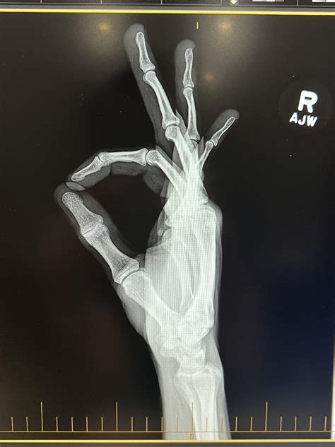 Lingering Thumb Pain Mcp Joint Area And Some Ip Joint Mri Report Included Rxrays Lingering Thumb Pain Mcp Joint Area And Some Ip Joint Mri Report Included Rxrays