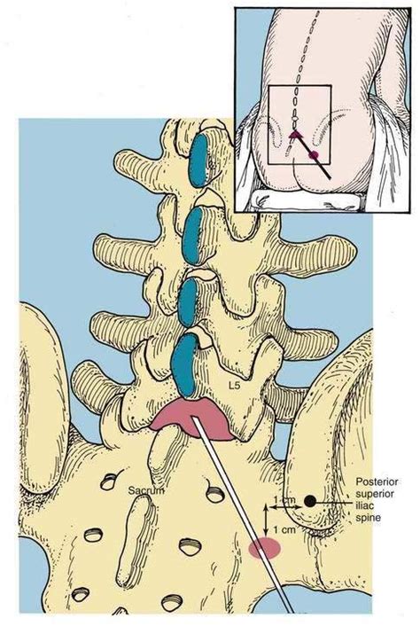 Spinal Block Anesthesia Key