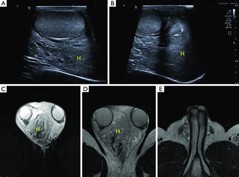 Penile Fracture Diagram