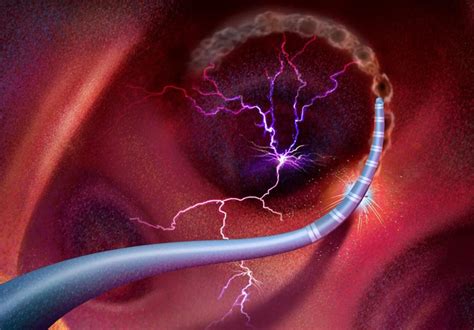 When Atrial Fibrillation Afib Ablation Timing Impacts Afib Recurrence