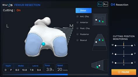 큐렉소 치료를 넘어 건강한 미래를 만드는 의료로봇 전문기업 병원신문