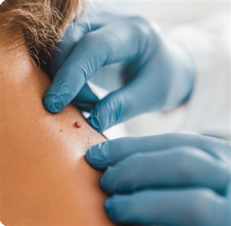 The Mole Clinic Skin Cancer Clinics