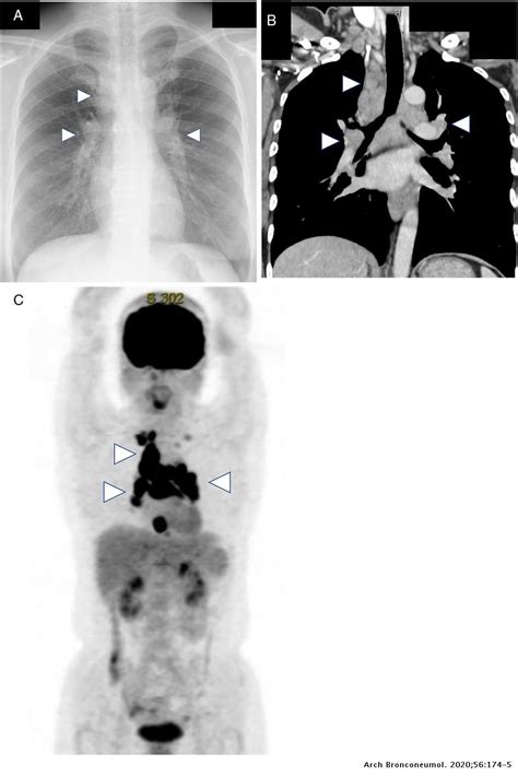 Lambda Sign Sarcoidosis Archivos De Bronconeumología