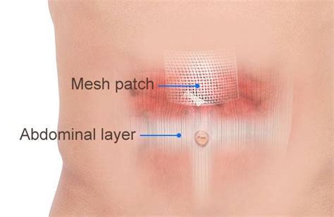 Internal Abdominal Scar Tissue Symptoms