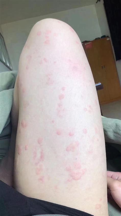 荨麻疹反复发作，是身体发出的求救信号 知乎