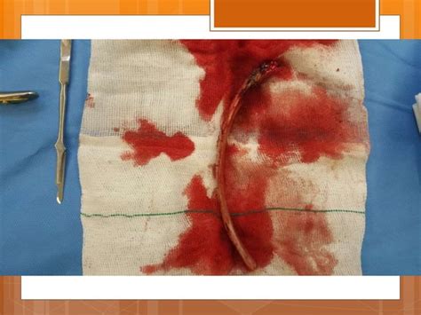 Thoracic Disc Disease Ppt