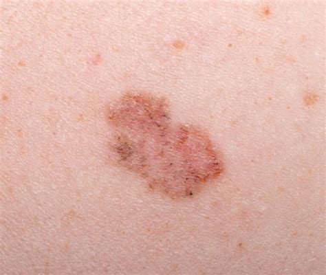 Basal Cell Carcinoma Bcc Symptoms Causes And Treatment