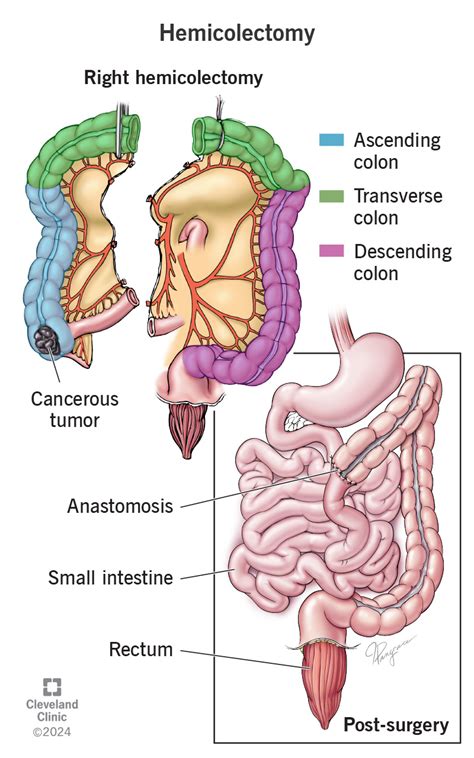 Hemicolectomy What It Is Types Surgery And Recovery