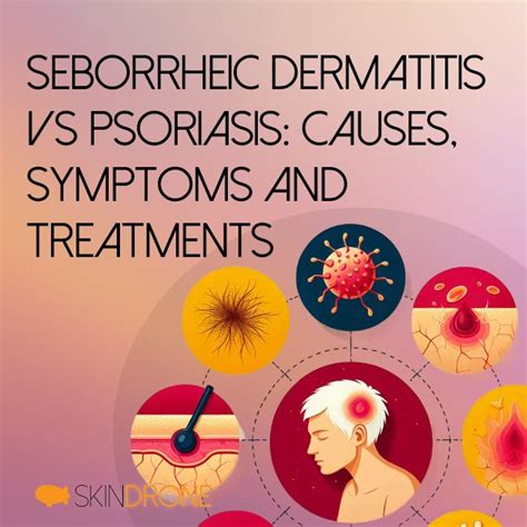 Seborrheic Dermatitis Vs Psoriasis Whats The Difference Sfostsee