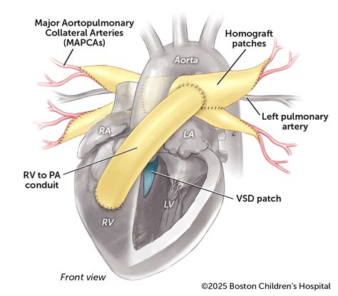 Major Aortopulmonary Collateral Arteries Mapcas