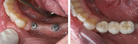 Replacing Multiple Teeth With Implants Windsor Dentists North Brisbane