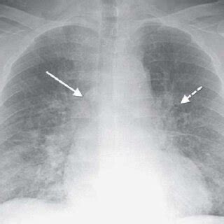 Bilateral Diffuse Interstitial Cardiac Diagnostics Including An Download Scientific Diagram