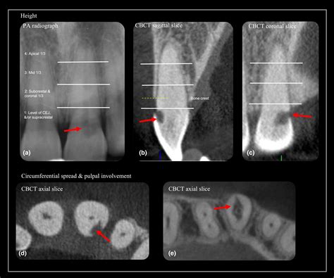 External Cervical Resorption A Three‐dimensional Classification Patel 2018 International