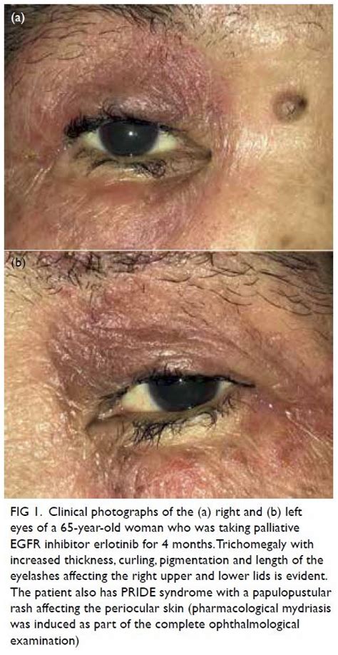 Eyelash Trichomegaly Induced By Erlotinib For Metastatic Lung Cancer Hkmj