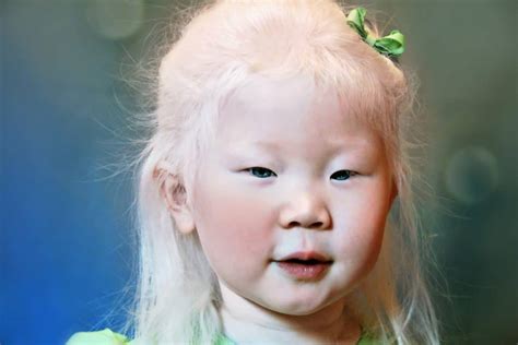 Causes And Consequences Of Albinism