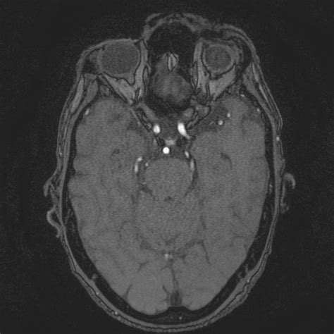 Neurovascular Compression Of Trigeminal Nerve Radiopaedia 67922 77361 Axial Mra Nc Commons