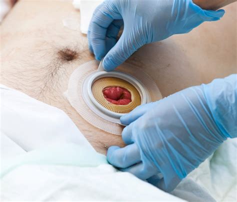 Before Your Stoma Surgery Preparation Tips And What To Expect