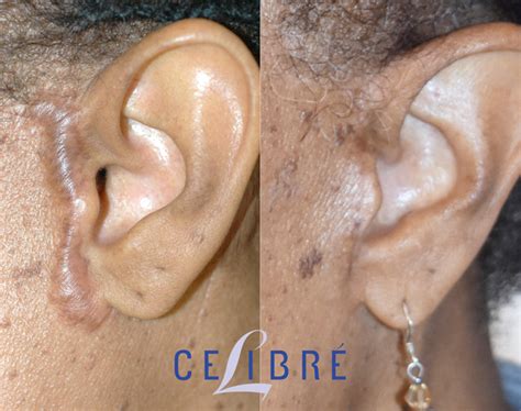 Keloid Makeup Saubhaya Makeup