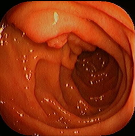 Normal Duodenum