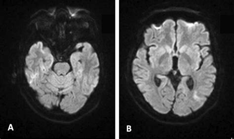 Mri Showed Subcortical And Cortical Oedema With A Predominance Of Download Scientific Diagram