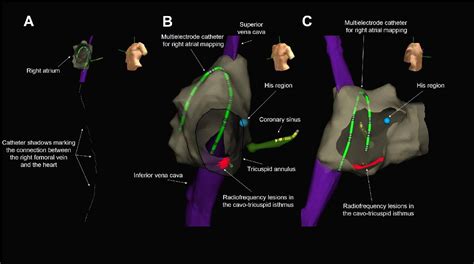 No Fluoroscopy For Cavotricuspid Isthmus Dependent Right Atrial Flutter