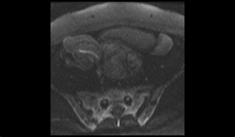MRI Gynae Fibroids EPI DWI Axial Images