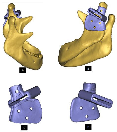 Design And Finite Element Analysis Of Patient Specific Total Temporomandibular Joint Implants