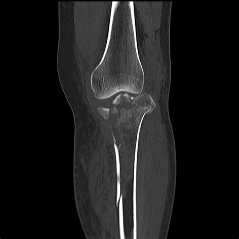 Radiopaedia Case Tibial Plateau Fracture Schatzker Type Vi Id 72658
