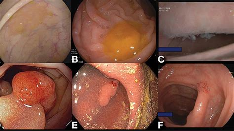 Natural Or Biologic Chromoendoscopy For Detection Of Colorectal Polyps Gastroenterology