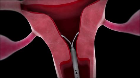 Insertion Of Intrauterine Device Into Uterus Stock Motion Graphics SBV Storyblocks