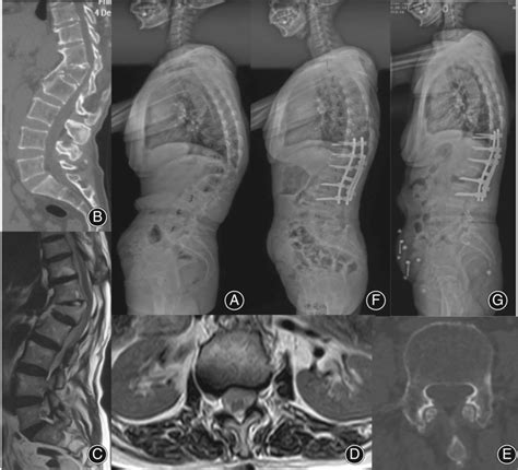 Posttraumatic Kyphosis Secondary To Old Fracture At L1 In A 63‐year‐old