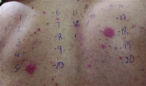 An Artisan With Hand Eczema Giving Positive Patch Test Reaction To