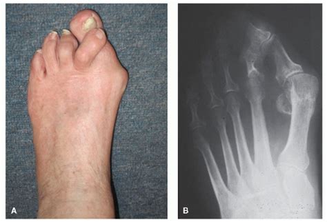 Transverse Plane Digital Deformities Musculoskeletal Key