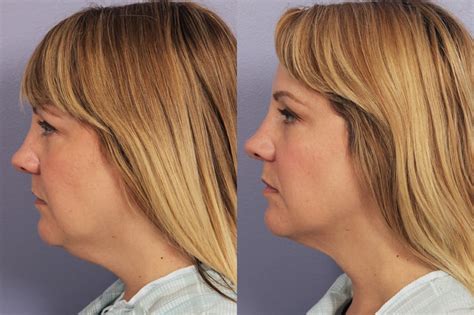 Coolsculpting Before And After Pics We Heart This
