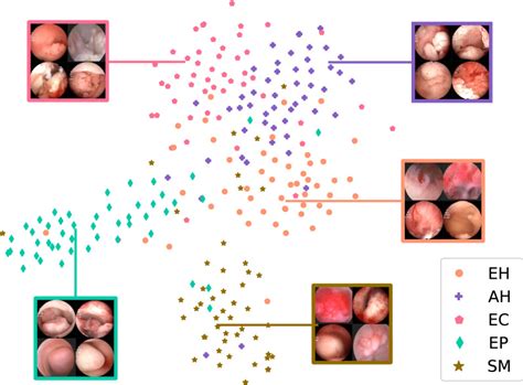 Deep Learning Model For Classifying Endometrial Lesions Pmc
