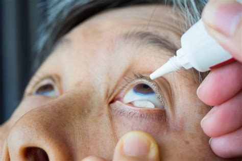 A Novel Dry Eye Classification Tool Optometry Advisor