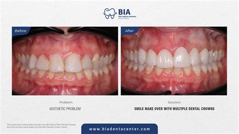 Smile Make Over With Multiple Dental Crowns Bali Implant Aesthetic