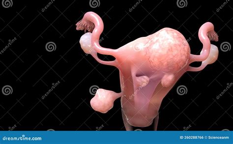 Medical Of Uterin Fibroid Tumor Ntramural Fibroid Subserosal Uteri