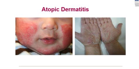 Cm 1 Immune Mediated Dermatologic Disorders Flashcards Quizlet