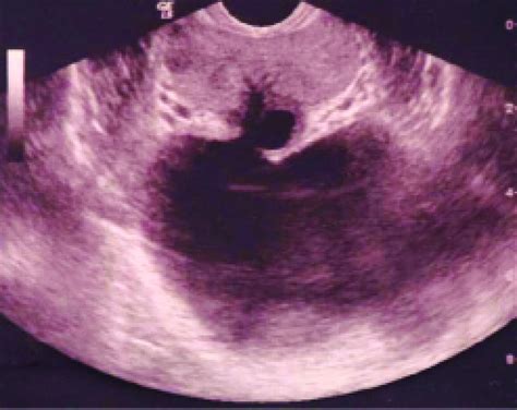 Prostatic Cyst Visualized At Transrectal Ultrasound Download